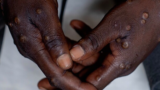 Fastslår at mpox-risikoen er moderat